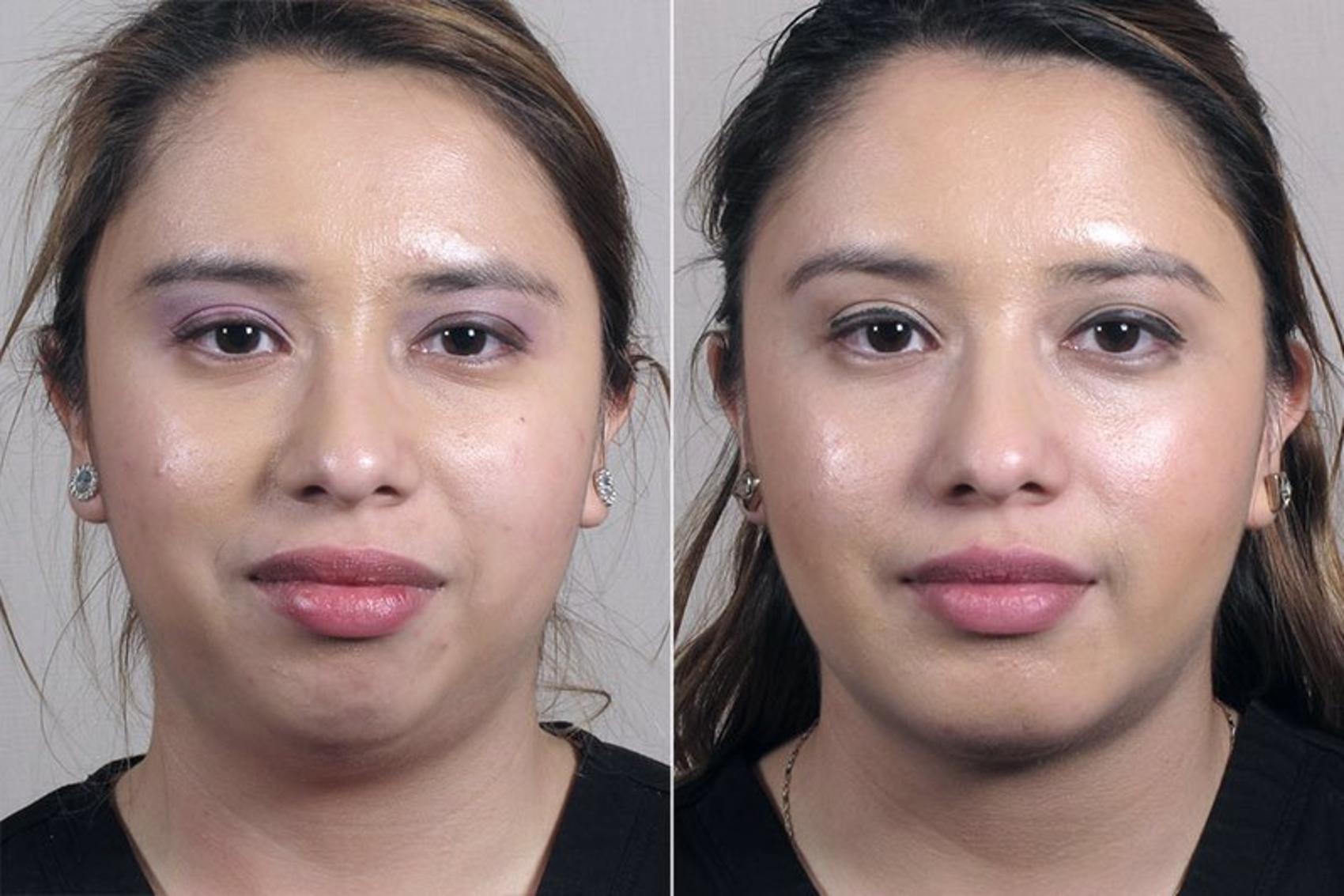 Chin Implants Before and After Pictures Case 228 | Paramus, New Jersey | Parker Center for ...