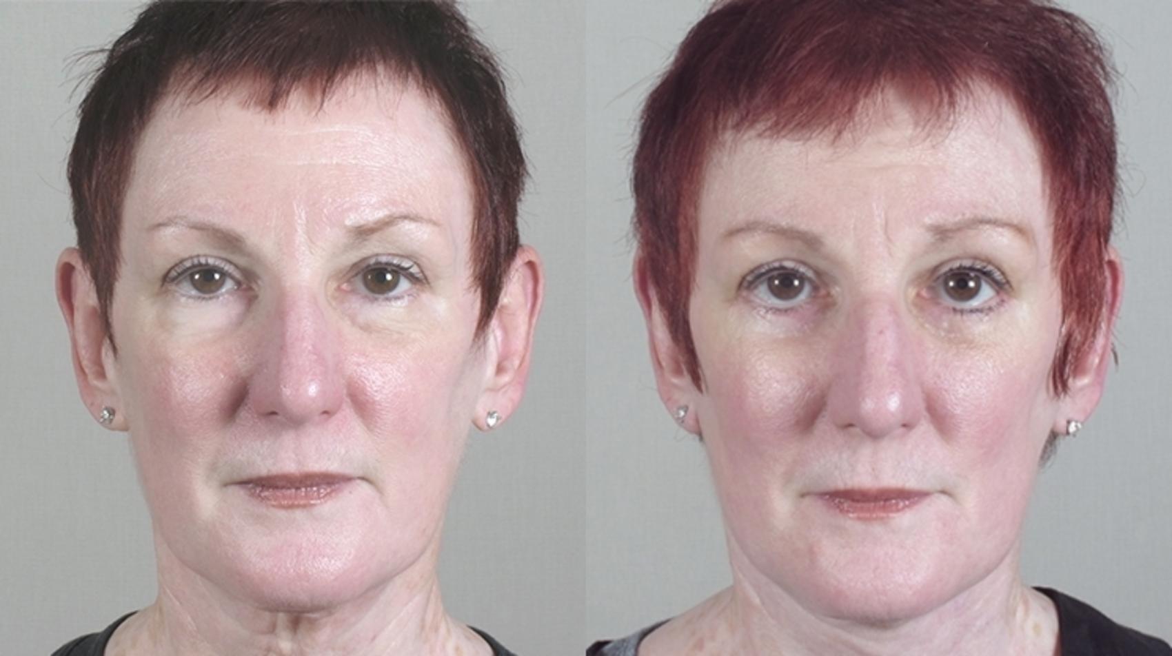 Neck Contouring Before and After Pictures Case 1171 | Paramus, New ...