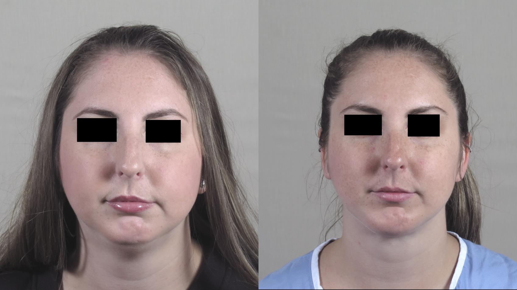 Neck Contouring Before and After Pictures Case 1251 | Paramus, New ...