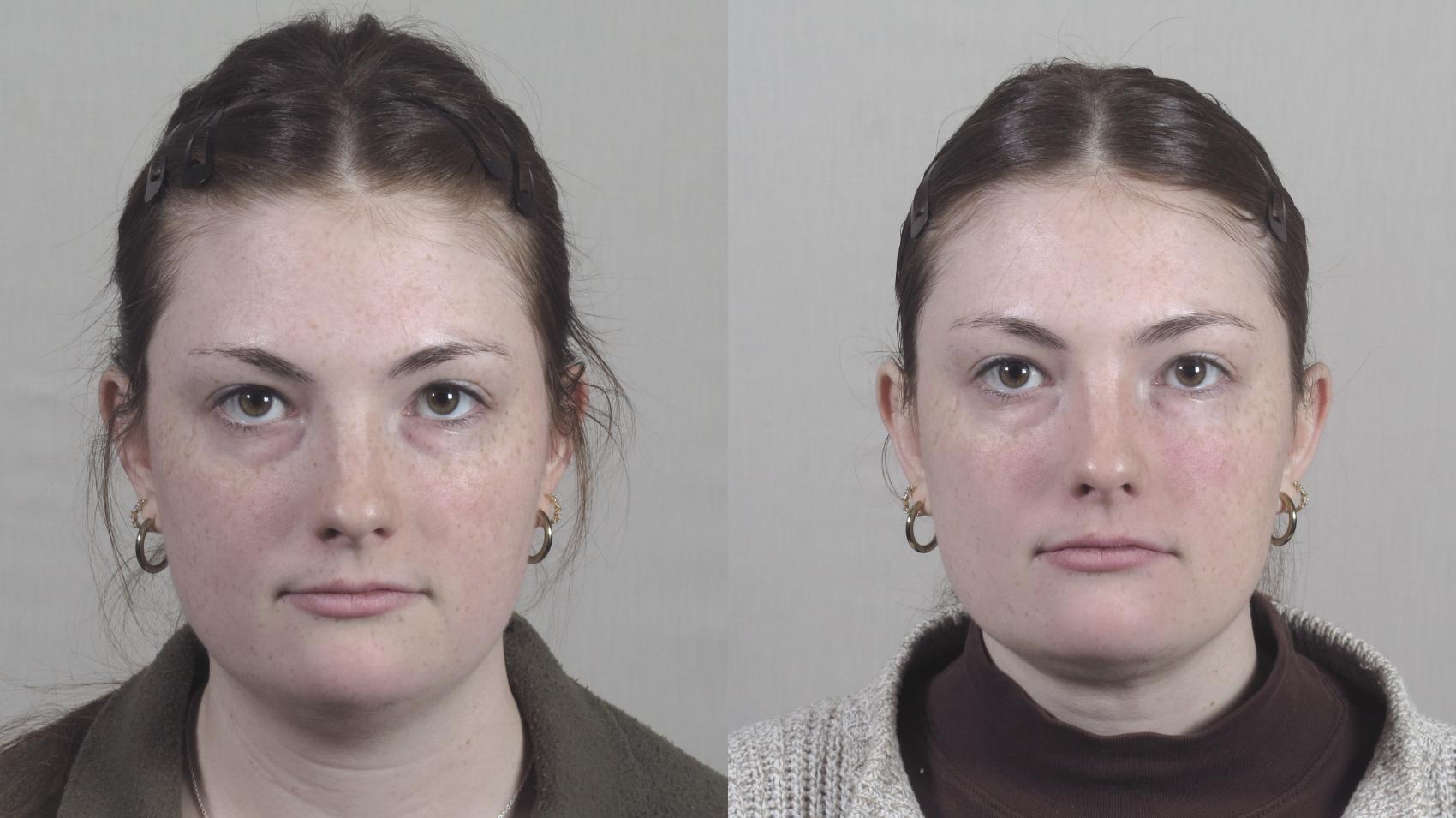 Neck Contouring Before and After Pictures Case 1391 | Paramus, New ...