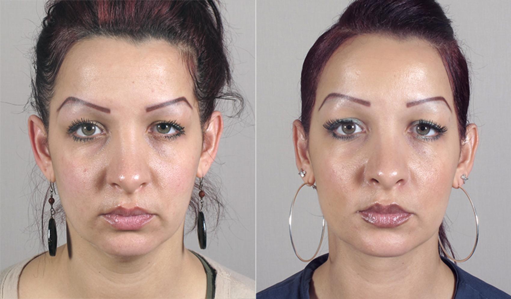 Neck Contouring Before and After Pictures Case 221 | Paramus, NJ ...