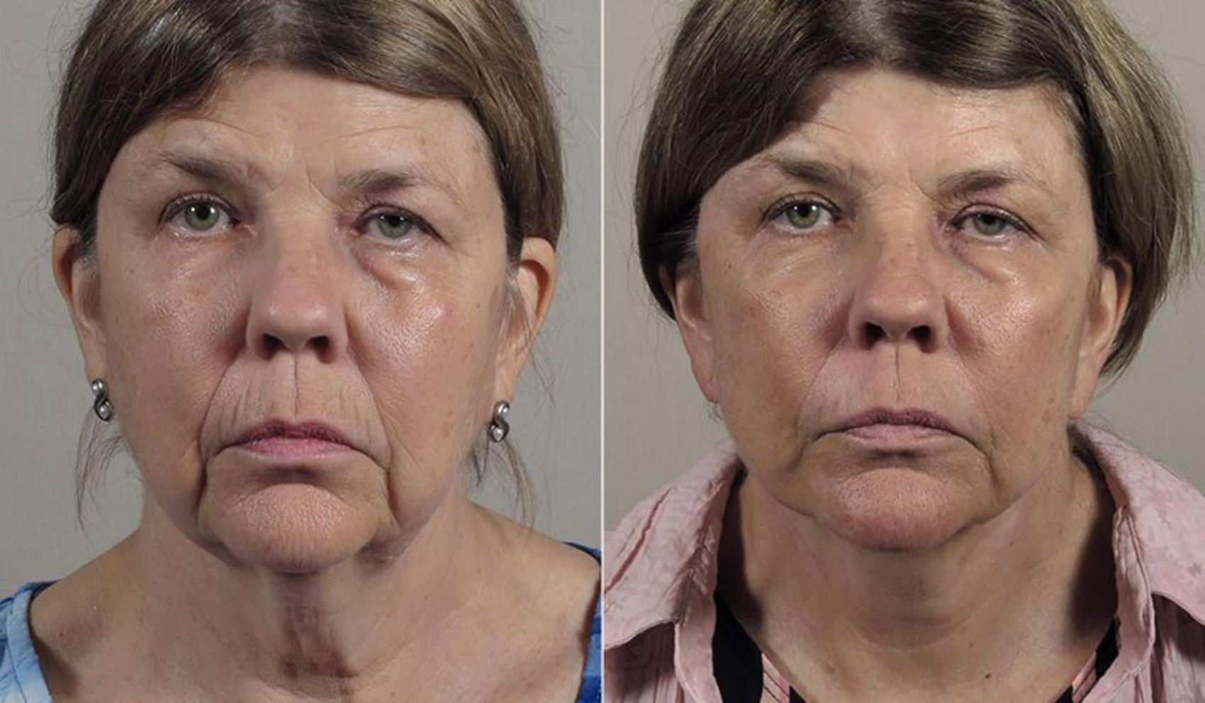 Neck Contouring Before and After Pictures Case 230 | Paramus, NJ ...