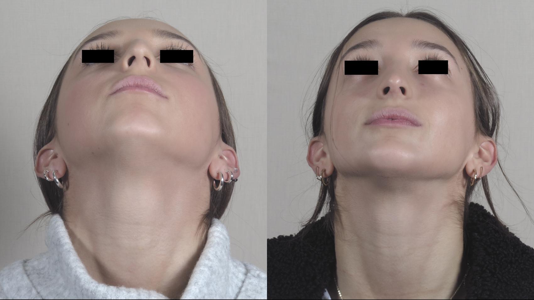 Rhinoplasty Before and After Pictures Case 1480 | Paramus, New Jersey ...